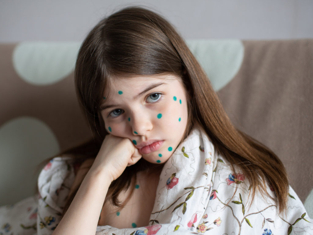 History of Chickenpox and How the Vaccine Changed Everything